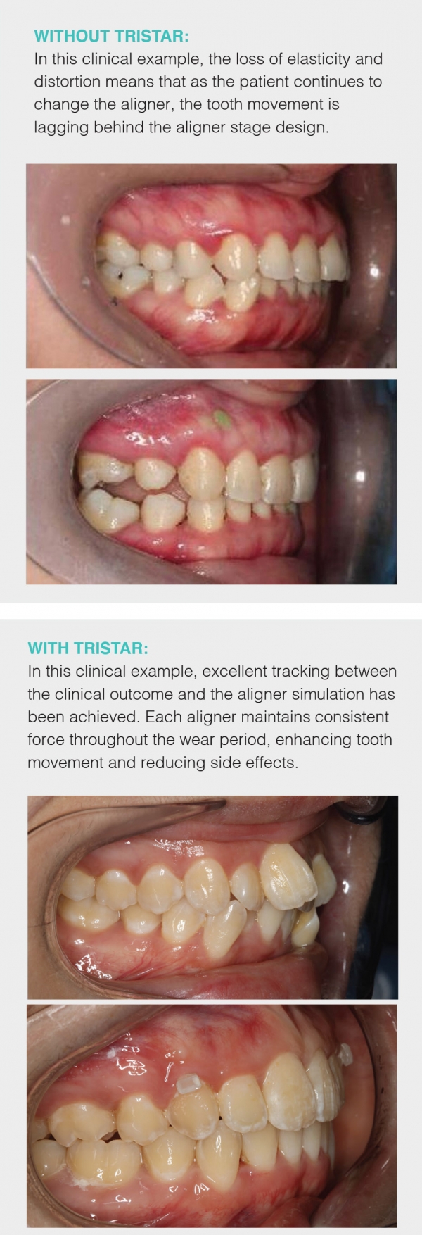 Tristar Trubalance - TRISTAR - Clear Aligner Material