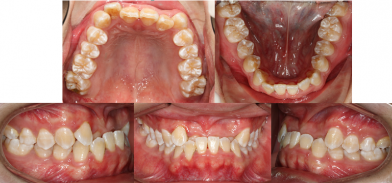 Composite clear aligner treatment in a pseudo class III malocclusion ...