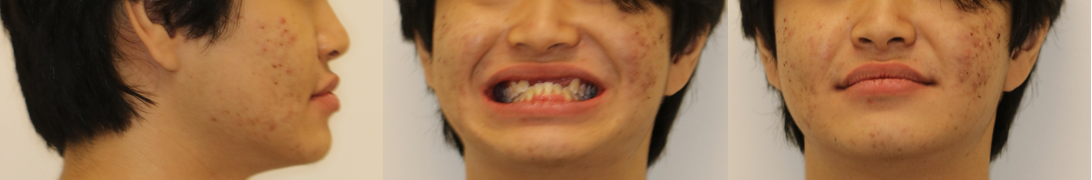 Composite Clear Aligner Treatment In A Pseudo Class III Malocclusion ...